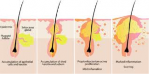 Cicatrici: da acne, post-operatorie, ipertrofiche, cheloidi - Il Mondo ...